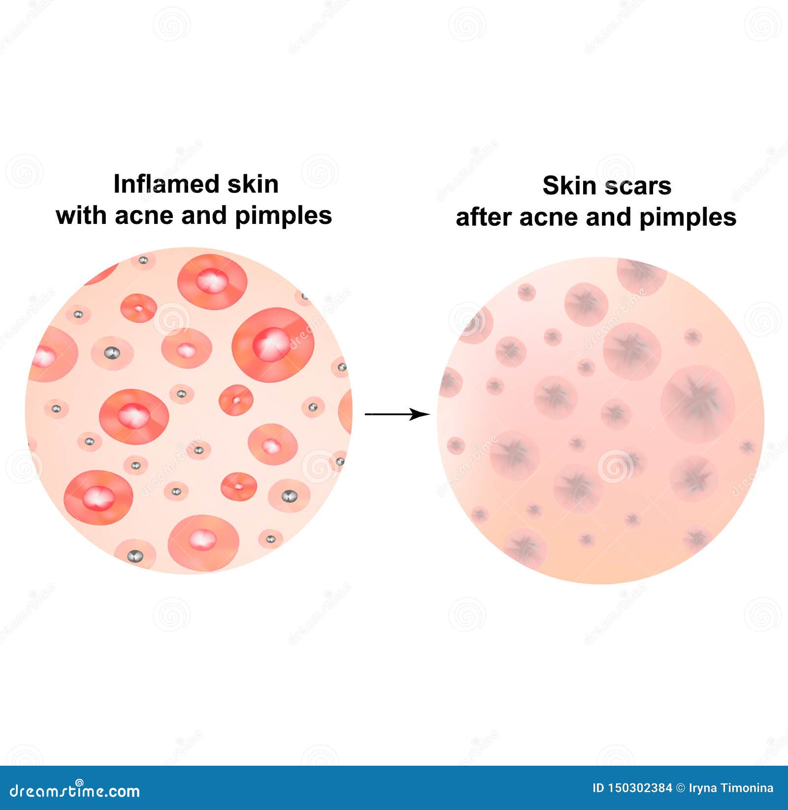 Types Of Blackheads Pustule Acne Scarred Skin After Acne And Acne