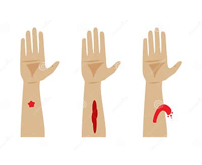 Types of Bleeding. Vector Illustration Stock Vector - Illustration of ...