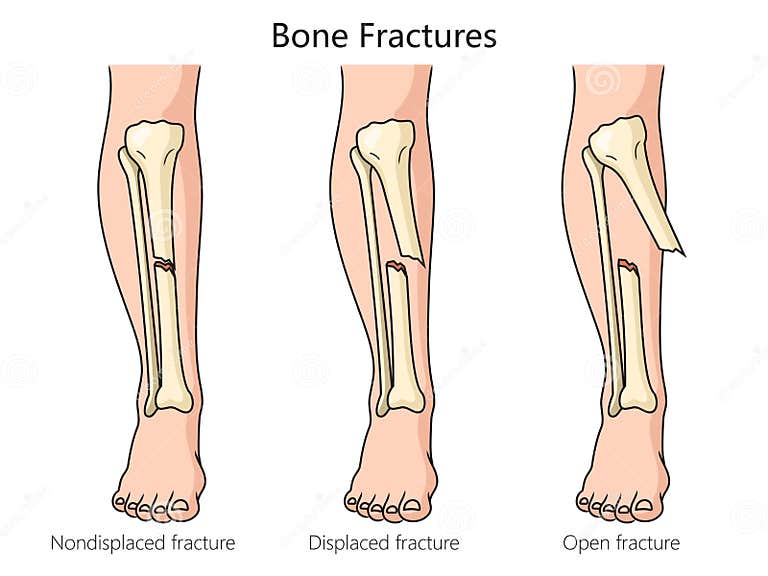 Types of Bone Fractures Diagram Medical Science Stock Illustration ... Types of Bone Fractures Diagram Medical Science Stock Illustration ...