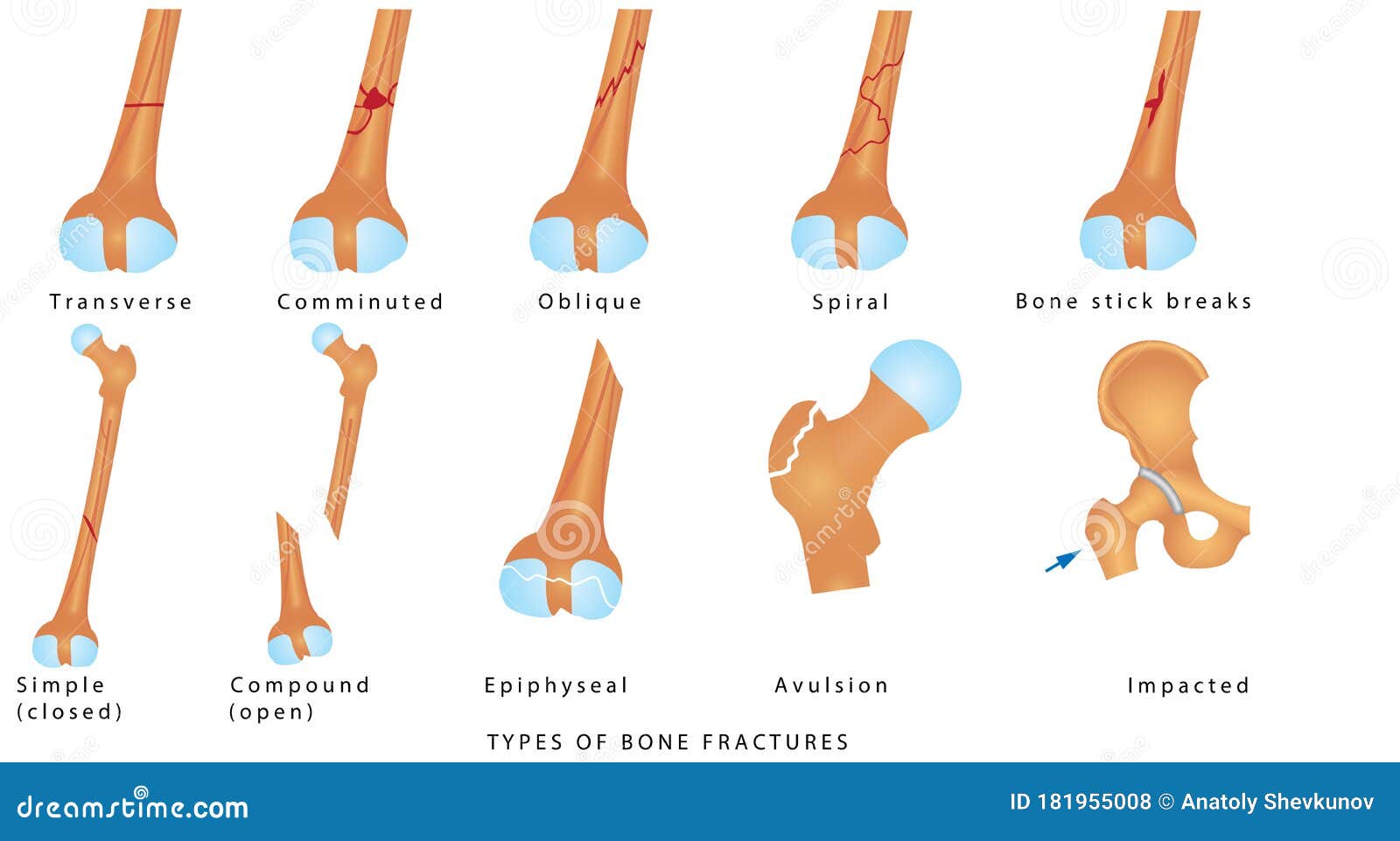 Types of Bone Fractures 向量例证. 插画 包括有 骨头的, 类型, 股骨, 矫形 - 181955008