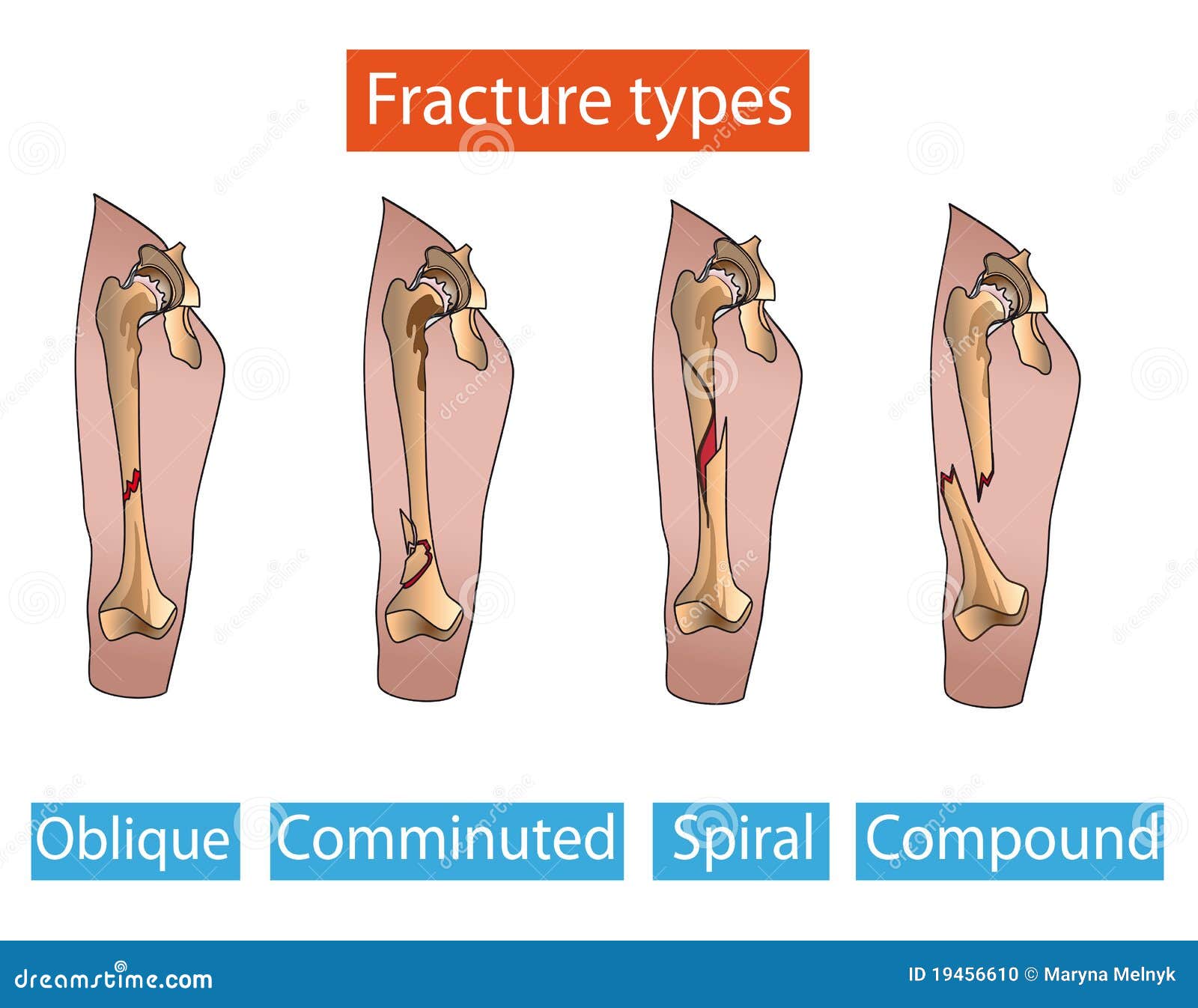 Types of Bone Fractures Leg Stock Illustration - Illustration of ... Types of Bone Fractures Leg Stock Illustration - Illustration of ...