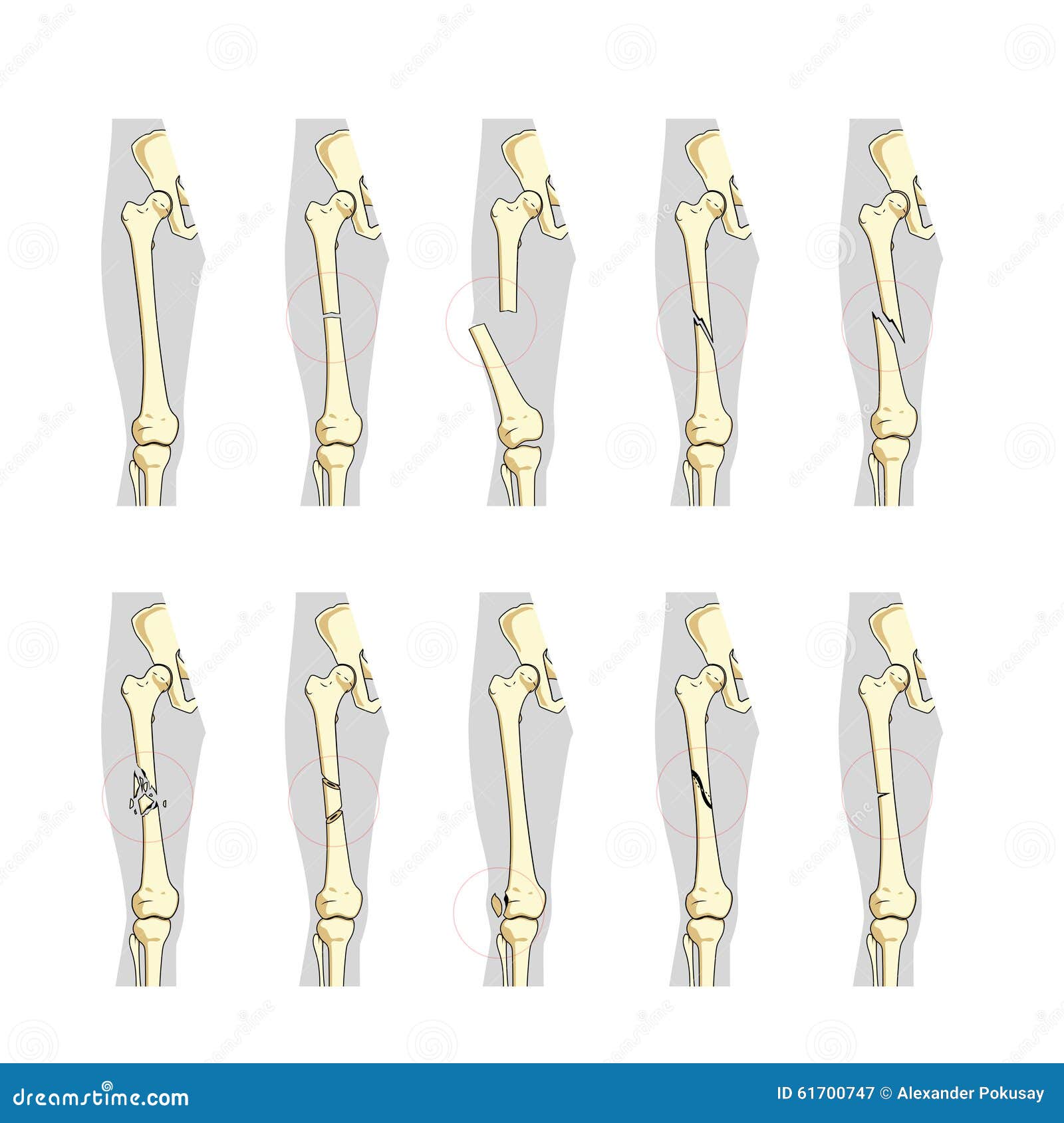 Types Of Bone Fractures Medical Educational Vector | CartoonDealer.com ... Types Of Bone Fractures Medical Educational Vector | CartoonDealer.com ...