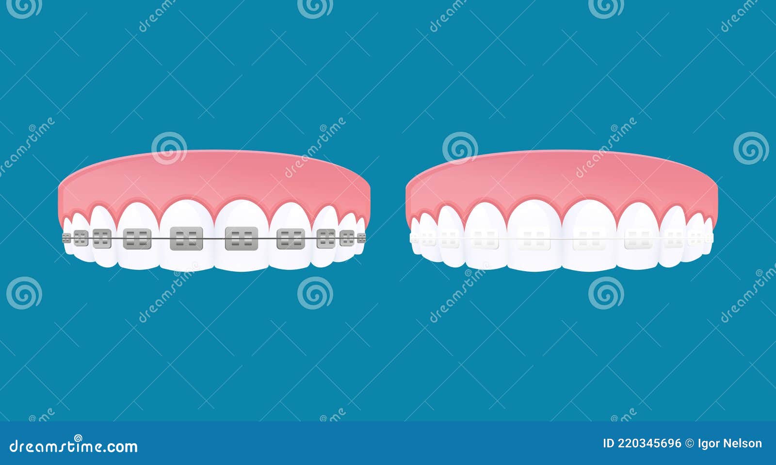 Clear Bracket Braces Before And After