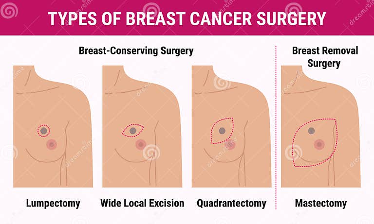 Types of Breast Cancer Surgery Lumpectomy, Quadrantectomy, Mastectomy ... Types of Breast Cancer Surgery Lumpectomy, Quadrantectomy, Mastectomy ...