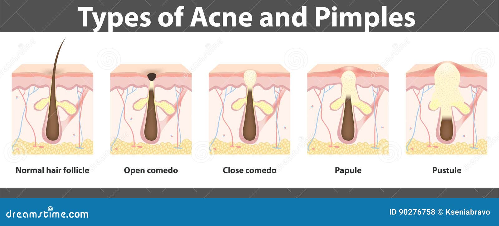 Types D'acné, Structure De Bouton, Illustration De Vecteur Illustration ...