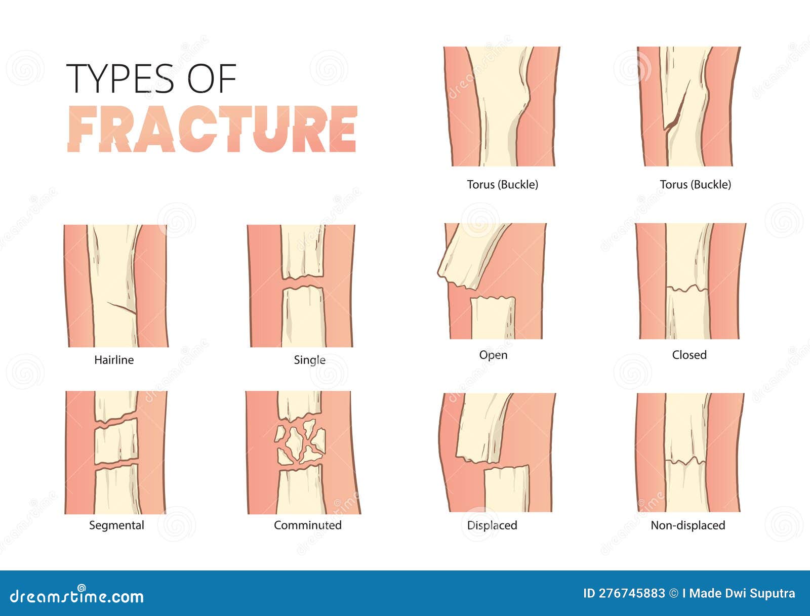 Types D'os Fractures Fractures Osseuses Classification Des Fractures ...