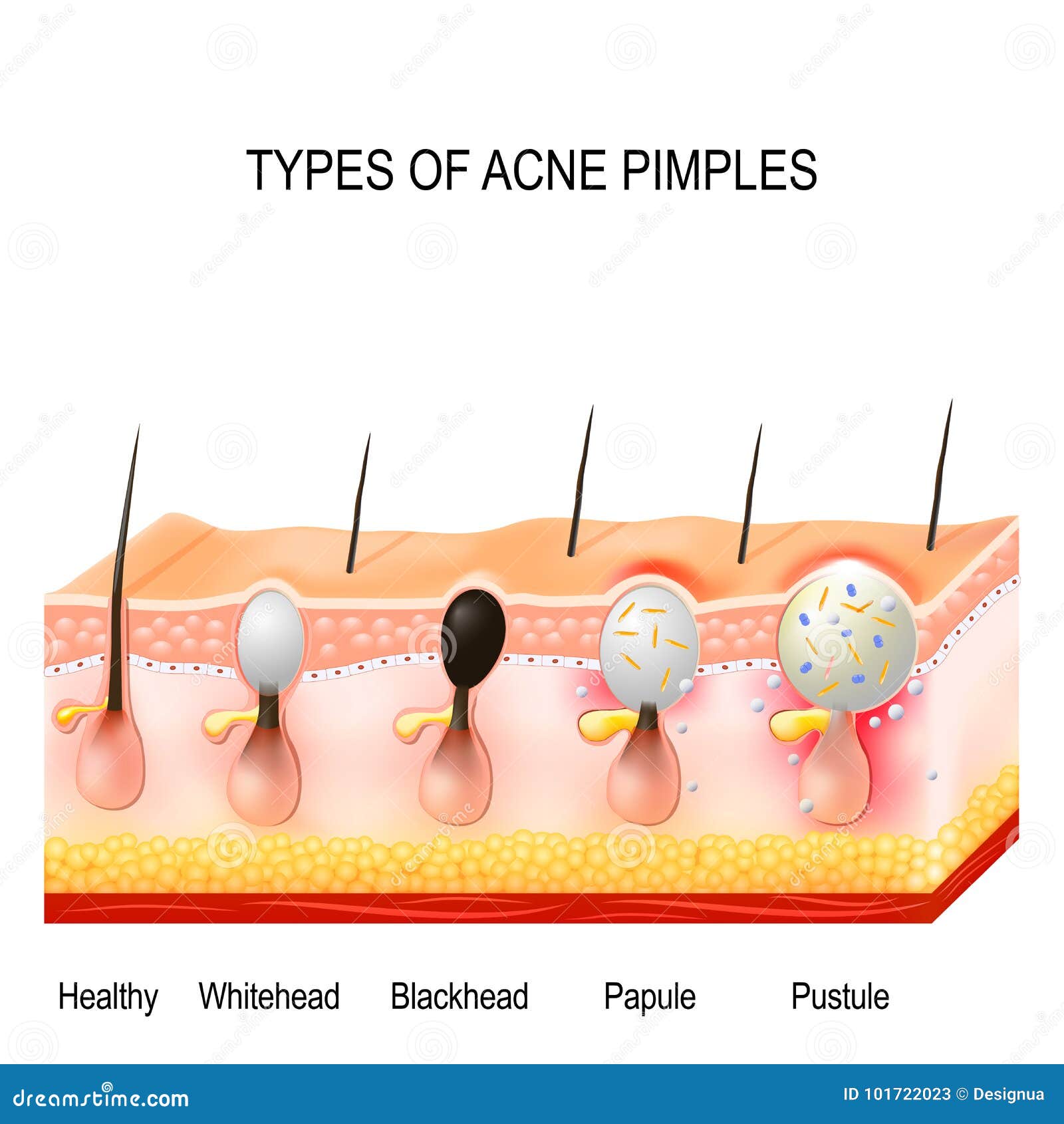 Types de boutons d'acné illustration de vecteur. Illustration du derme ...