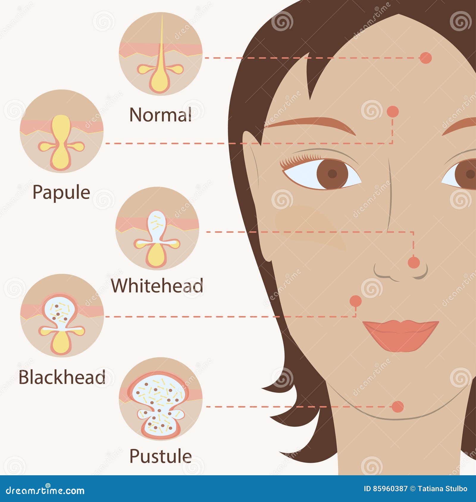 Types de boutons d'acné illustration de vecteur. Illustration du beauté ...