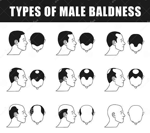Types De Calvitie Masculine Illustration de Vecteur - Illustration du ...