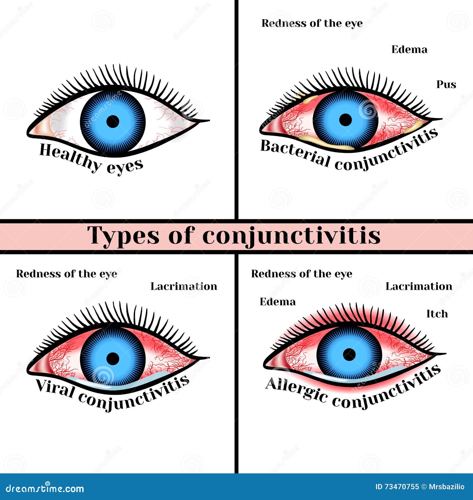Types De Conjonctivite Maladies Inflammatoires Des Yeux Illustration de ...