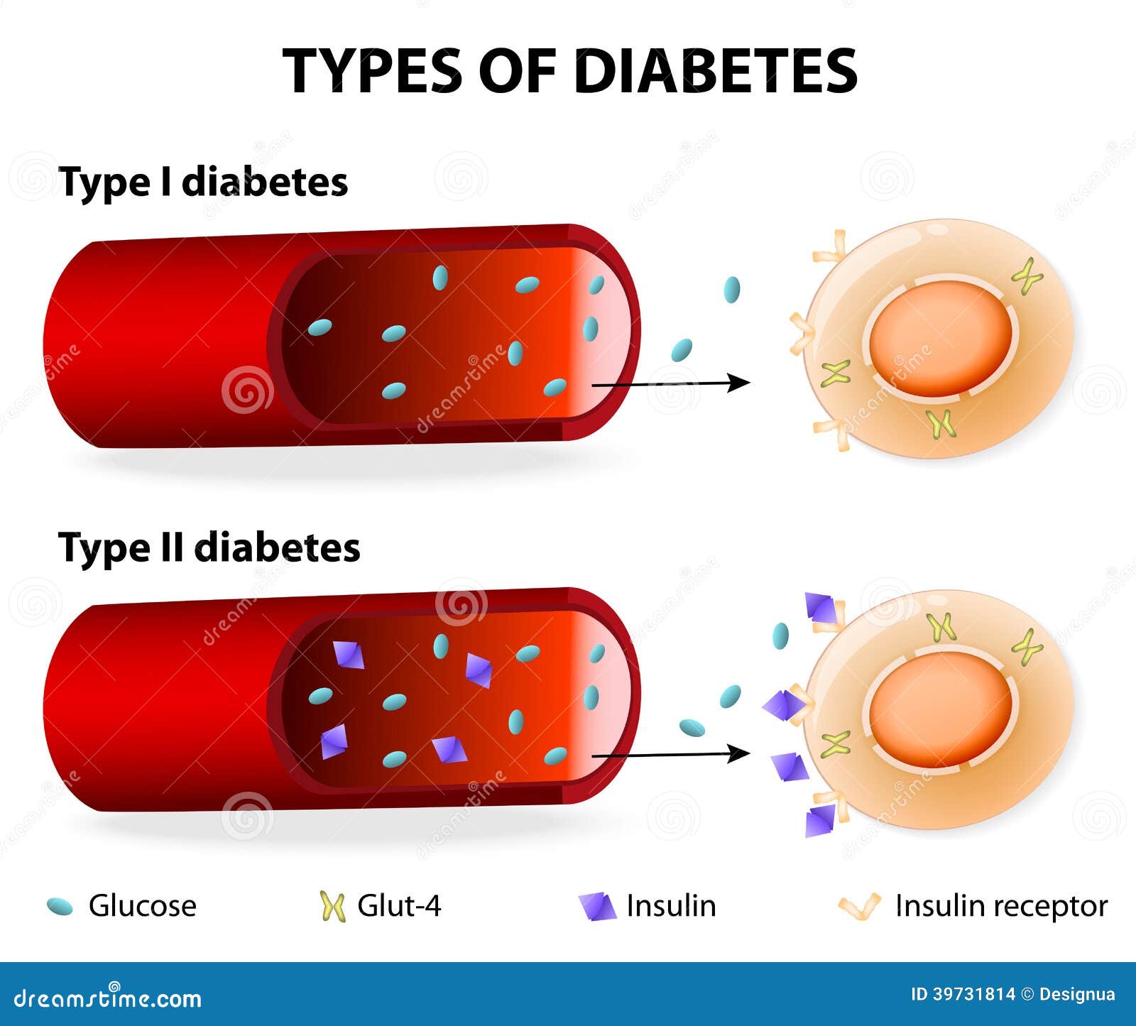 Types De Diabète Illustration de Vecteur - Image: 39731814