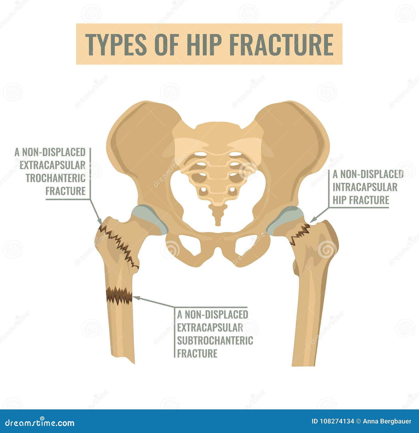 Types De Fracture De Hanche Illustration de Vecteur - Illustration du ...