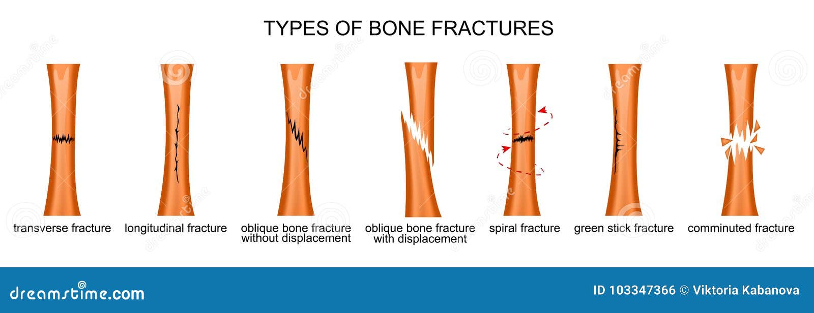 Types de fractures illustration de vecteur. Illustration du anatomie ...
