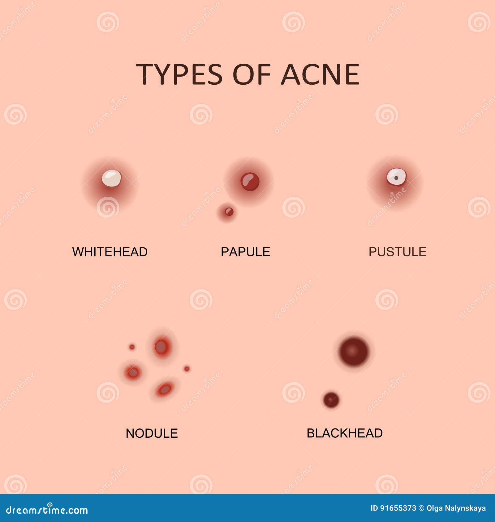 Types De L'acné Et De Boutons Illustration de Vecteur - Illustration du ...