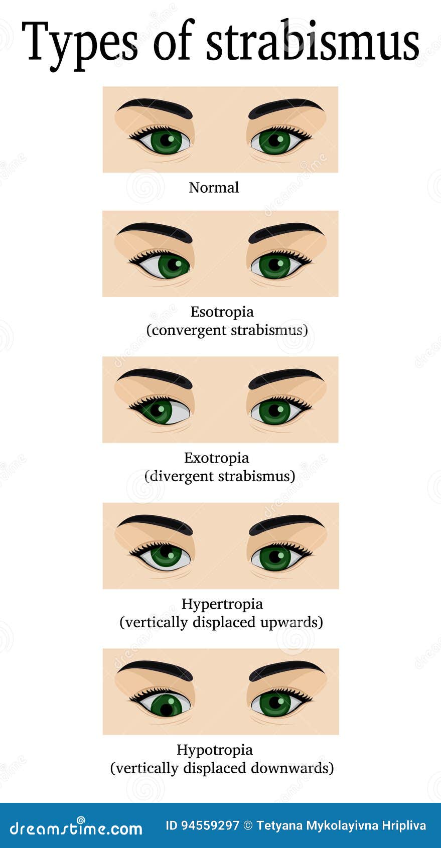 Types de strabismus illustration de vecteur. Illustration du maladie ...
