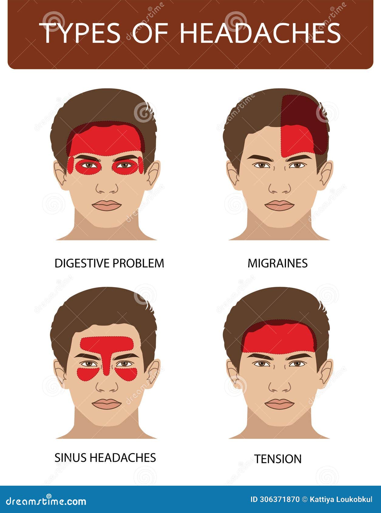 Types Of Headaches Migraine, Sinus, Tension, Digestive, Illustration On ...