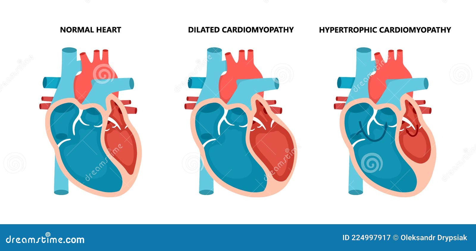 Types Of Heart Diseases Normal Hypertrophic And Dilated