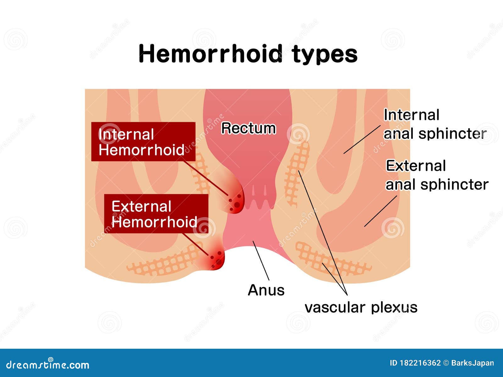 Types of Hemorrhoid Flat Vector Illustration Stock Vector - Illustration of internal, health ...