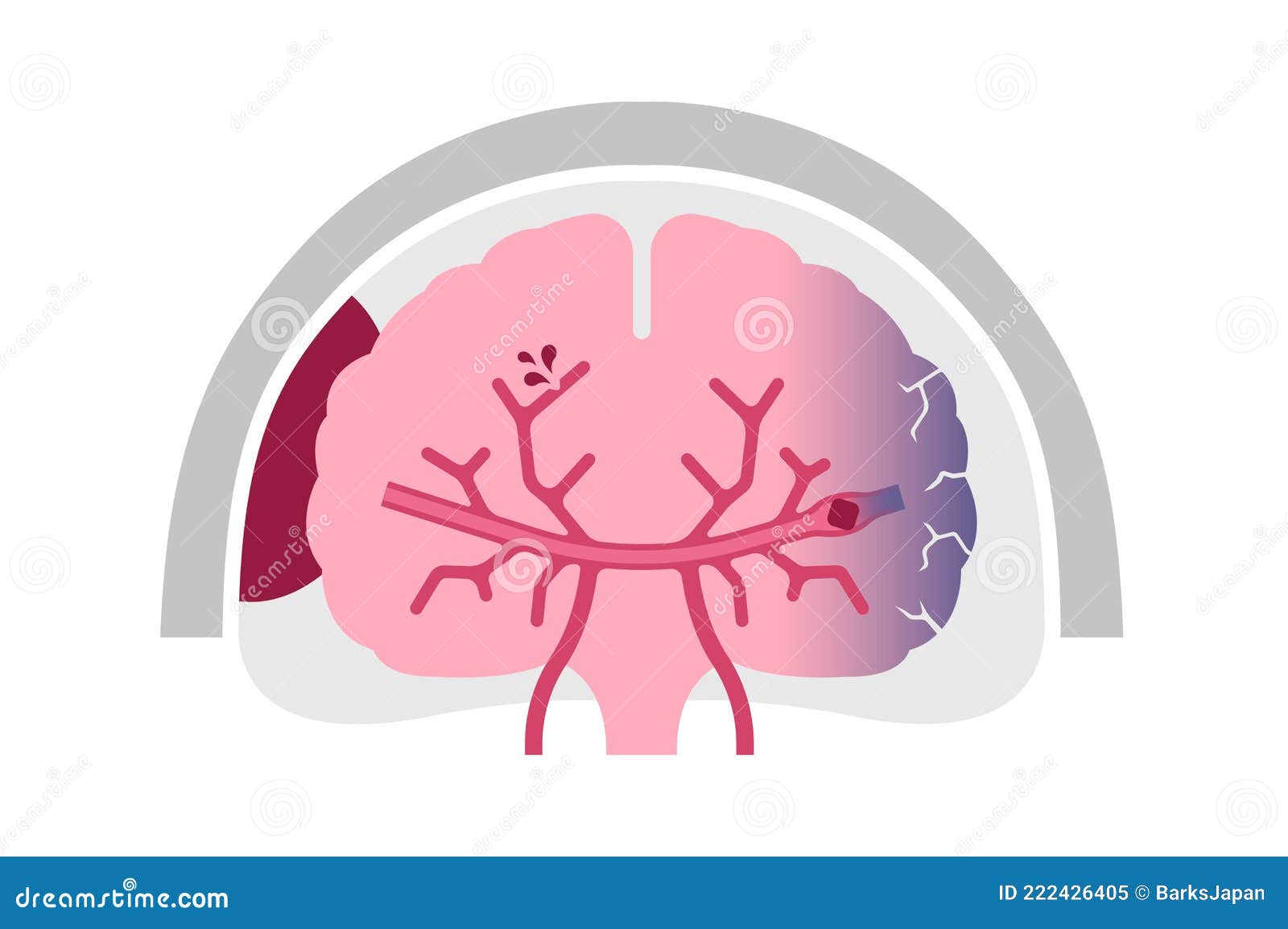 Types of Human Brain Stroke Vector Illustration Stock Vector ...
