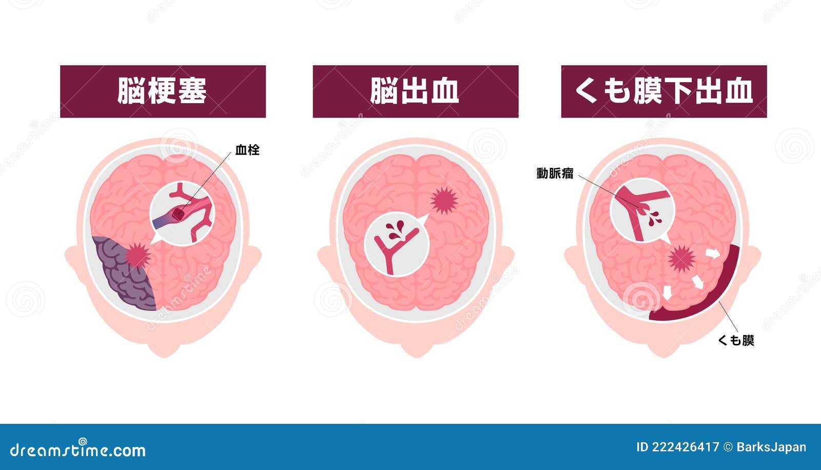 Types of Human Brain Stroke Vector Illustration Stock Vector ...