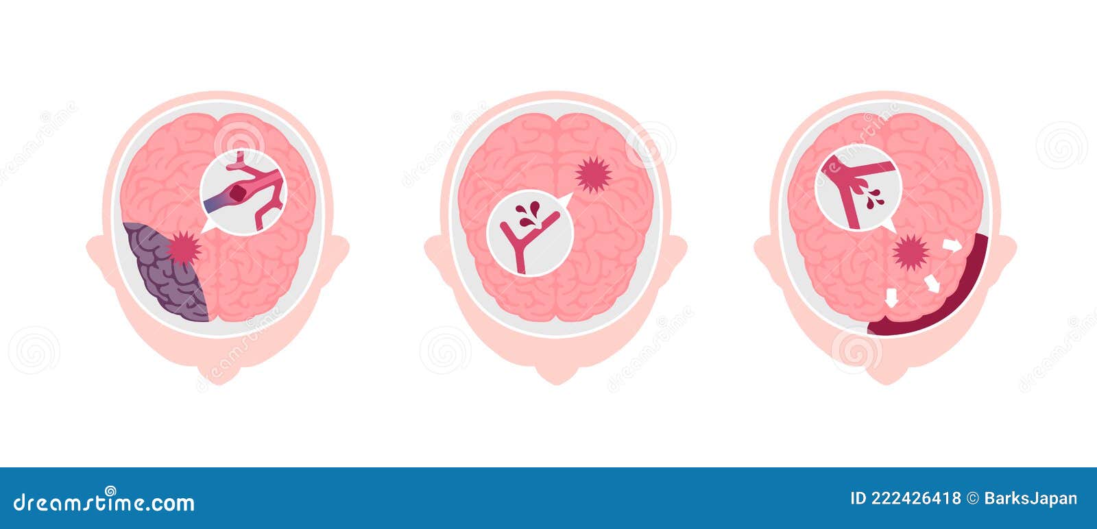 Types of Human Brain Stroke Vector Illustration Stock Vector ...