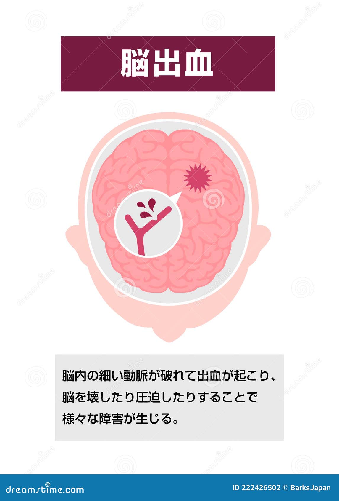 Brain Hemorrhage Intracranial Hematoma Cartoon Vector | CartoonDealer ...