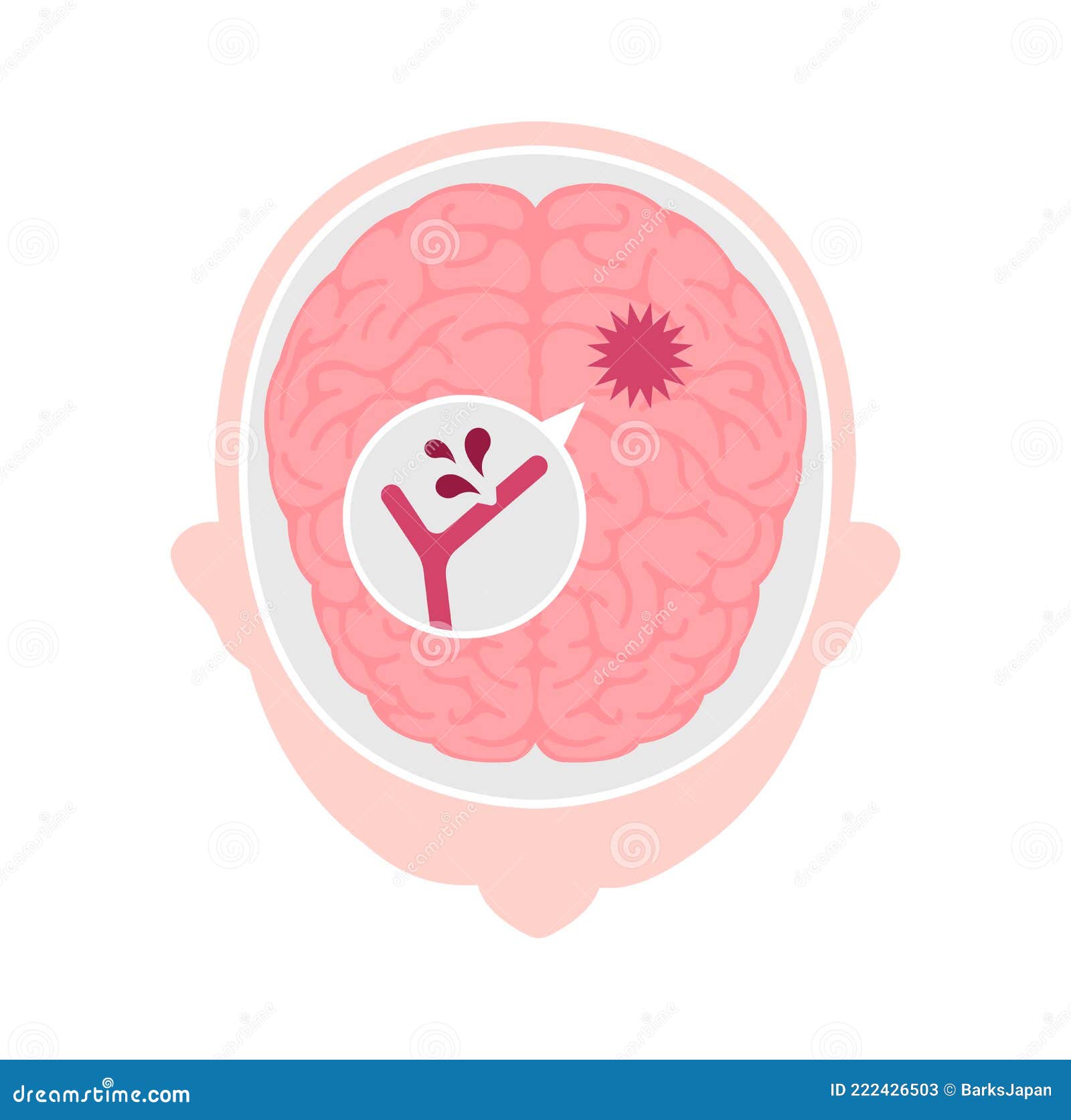Types of Human Brain Stroke Vector Illustration | Cerebral Hemorrhage ...