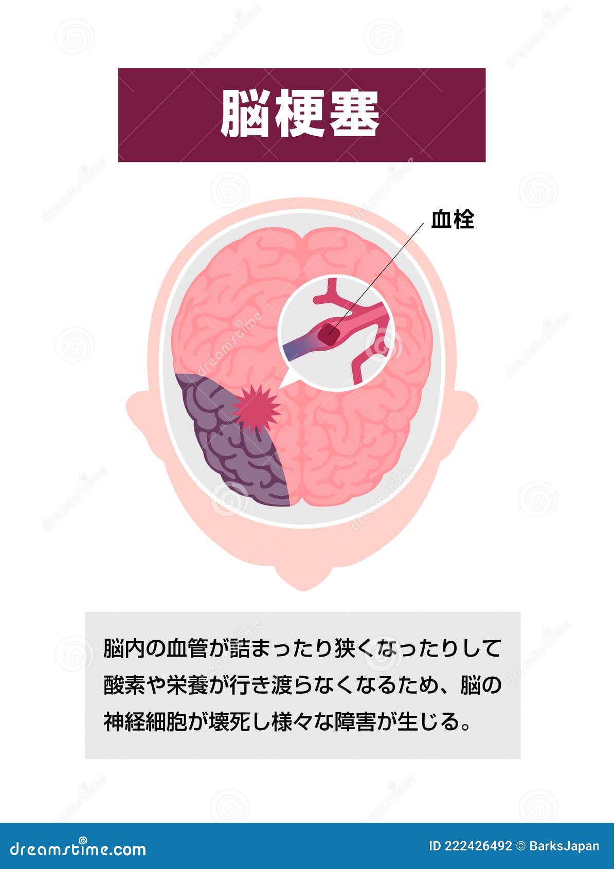 Cerebral Infarction Or Ischemic Stroke Cartoon Vector | CartoonDealer ...