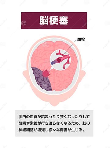 Types of Human Brain Stroke Vector Illustration | Cerebral Infarction ...