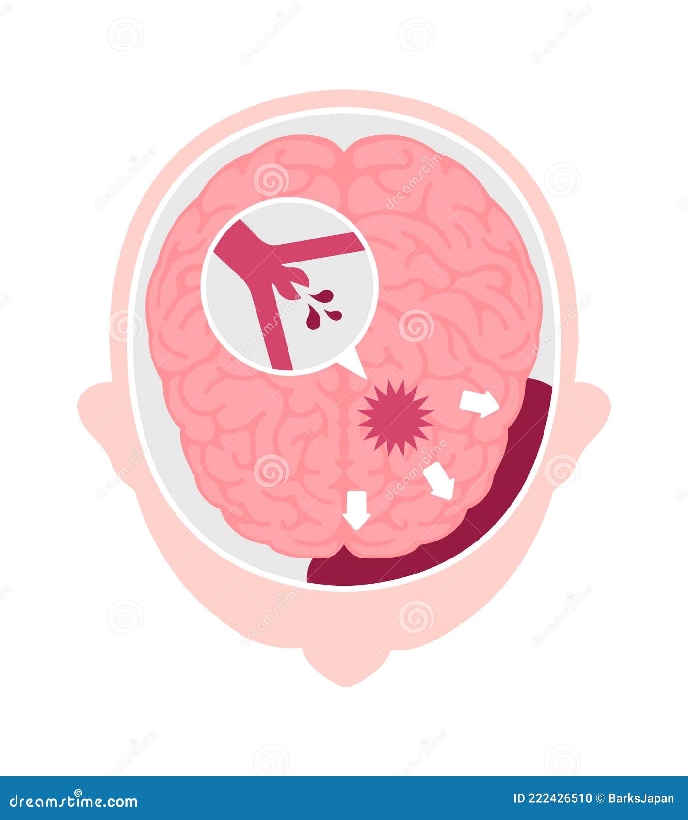 Brain Hemorrhage Intracranial Hematoma Cartoon Vector | CartoonDealer ...