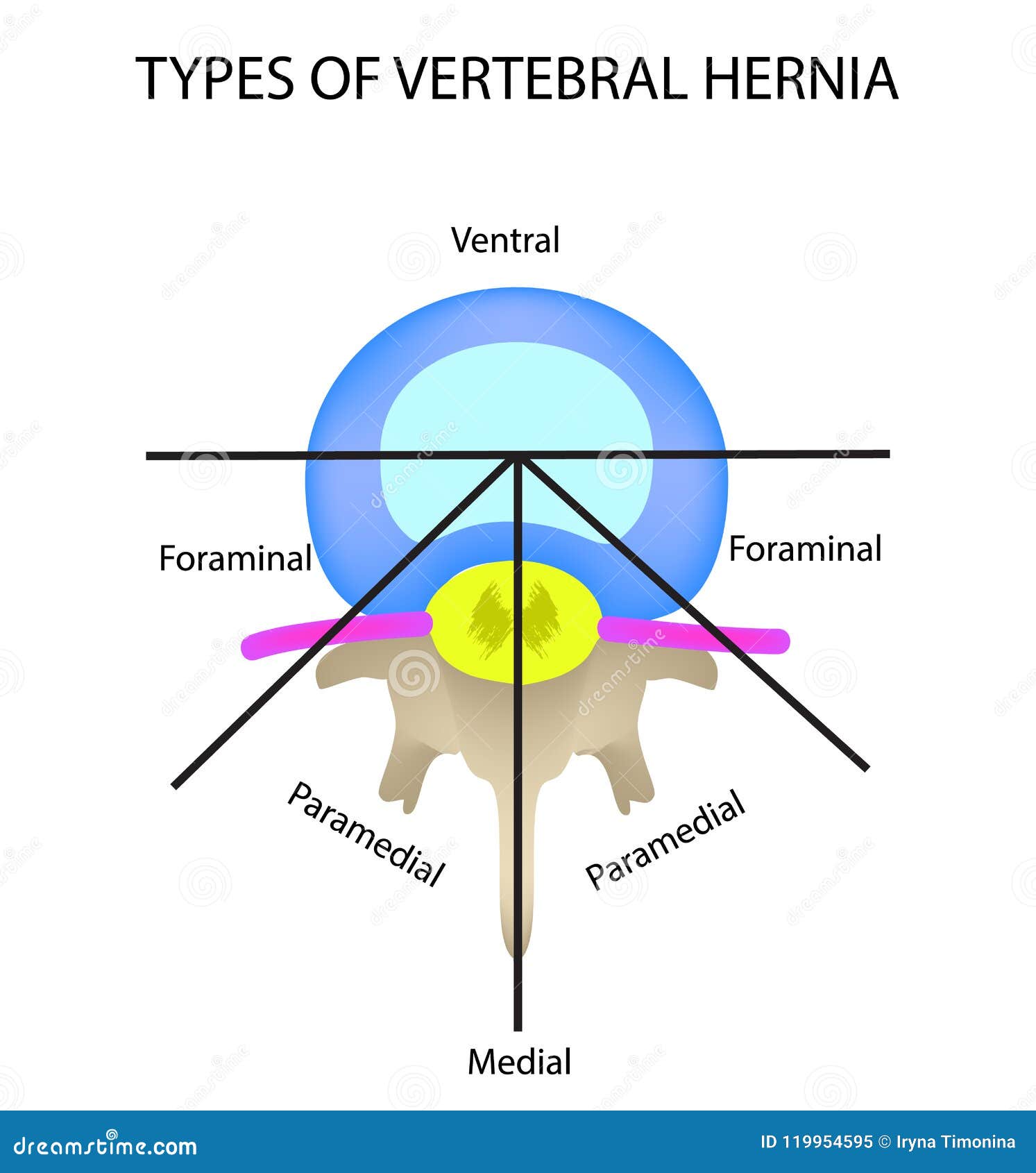 Types of Location of the Intervertebral Hernia. Vector Illustration on ...