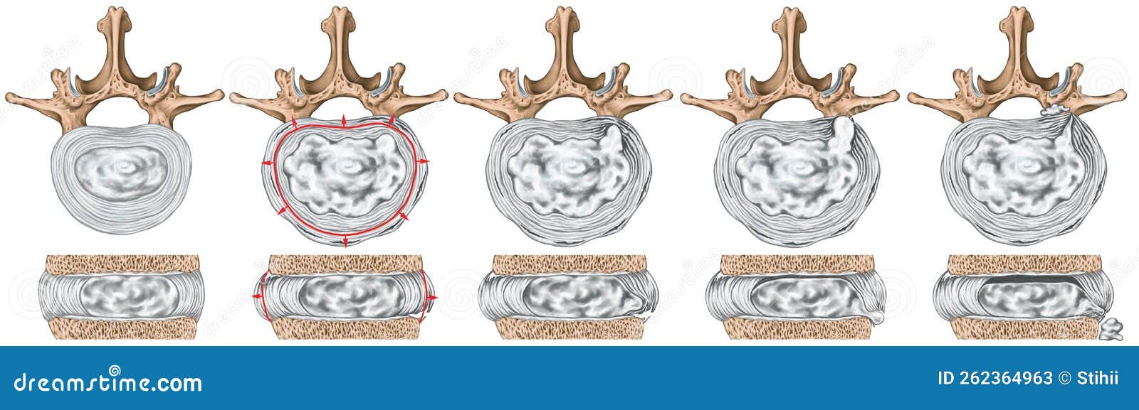 Types Of Lumbar Disc Herniation Stock Illustration Illustration Of