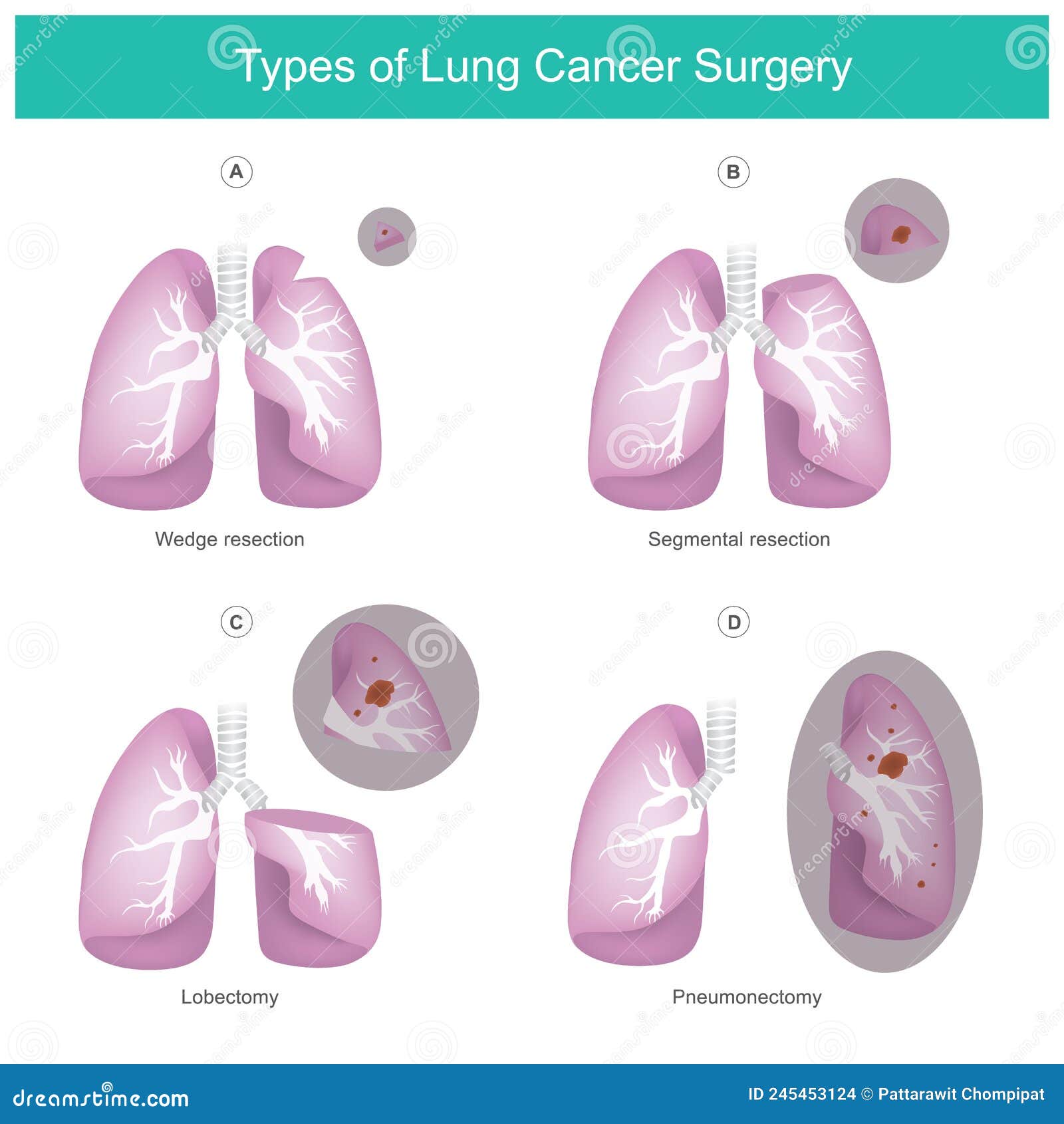 Biopsy: Types Of Biopsy Procedures Used To Diagnose Cancer Stock Image ...