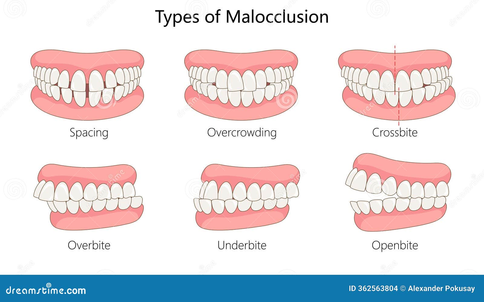 Types of Malocclusion Dental Diagram Medical Stock Illustration ...