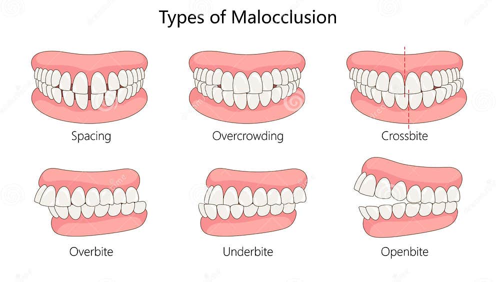 Types of Malocclusion Dental Diagram Medical Stock Illustration ...