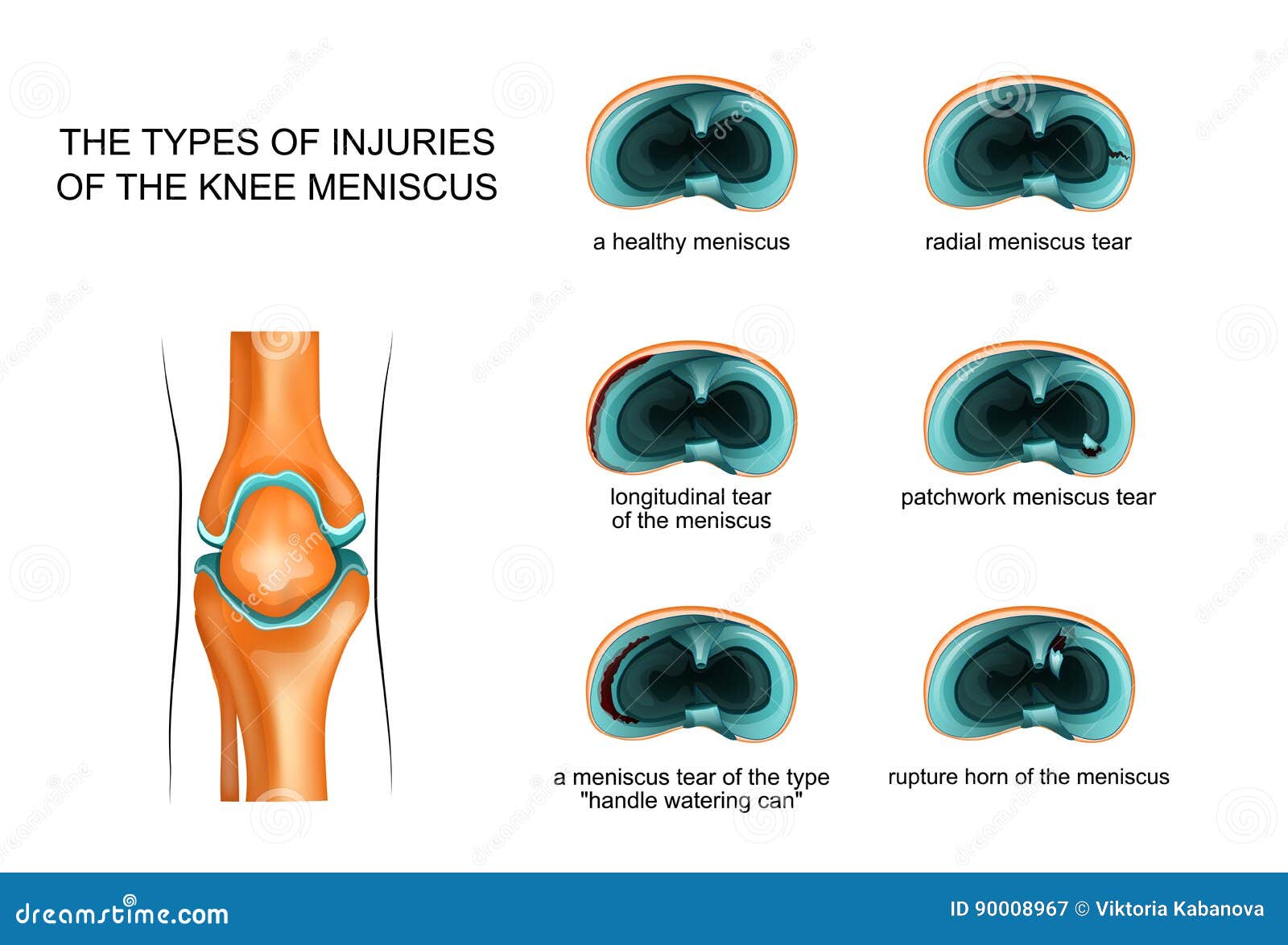 Types of meniscus tear stock vector. Illustration of orthopedy - 90008967
