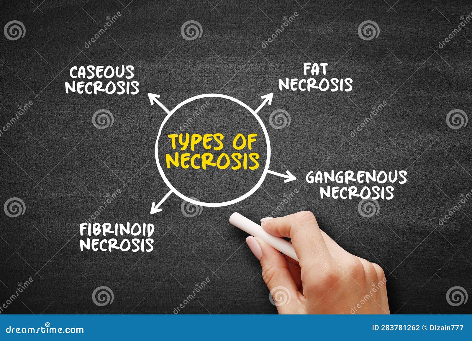 Types of Necrosis (death of Body Tissue) Mind Map Text Concept for ...