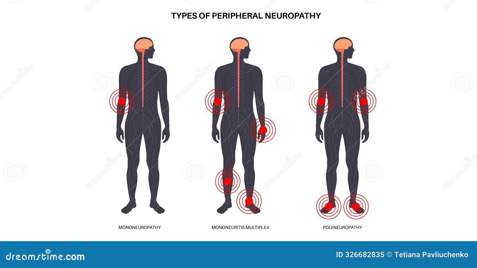 Peripheral Neuropathy Medical Poster Stock Illustration - Illustration ...