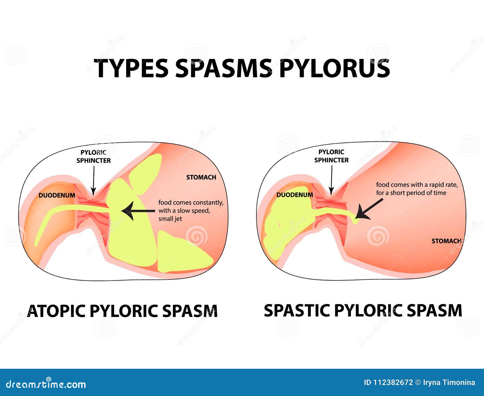 Types Of Spasms Of The Pylorus Pylorospasm Spastic And Atonic Pyloric Sphincter Of The