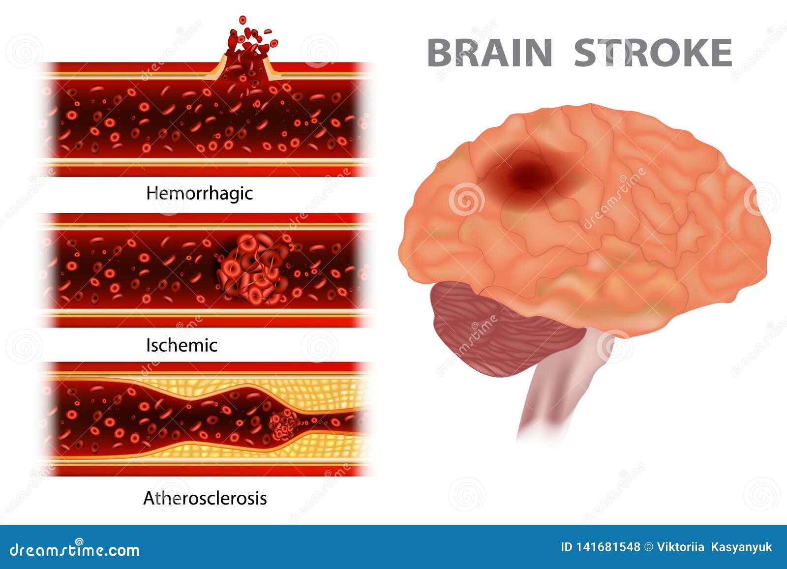 Types of Stroke. Vector Illustration Stock Vector - Illustration of ...