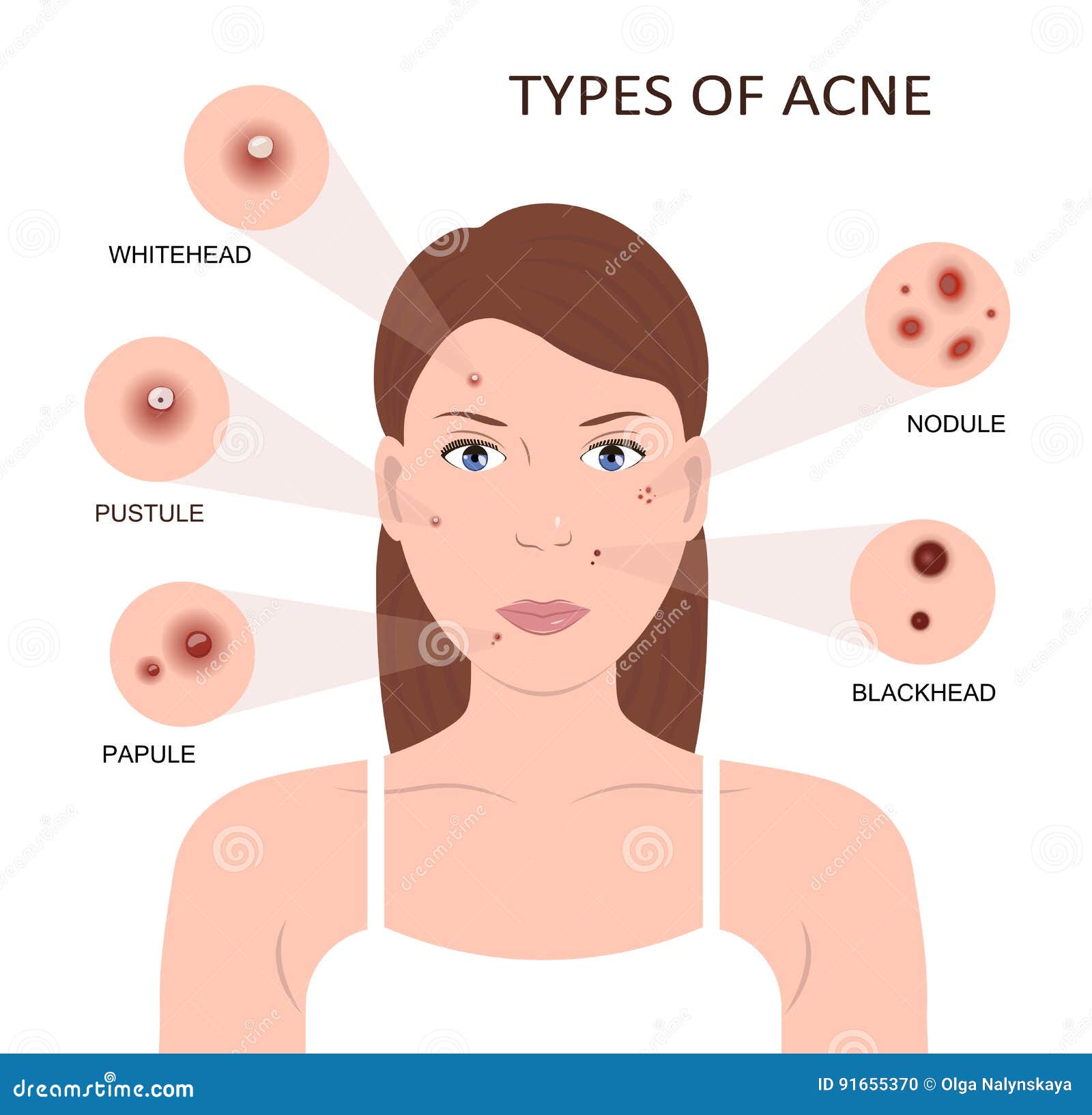 Types Van Acne Vrouw Met Pukkels Vector Illustratie - Illustration of ...