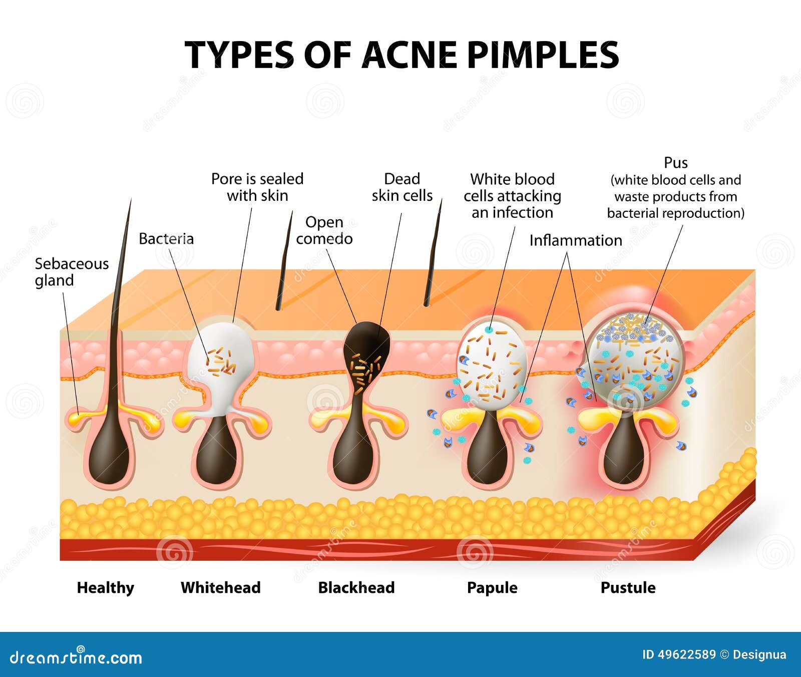 Types van acnepukkels vector illustratie. Illustration of cellen - 49622589