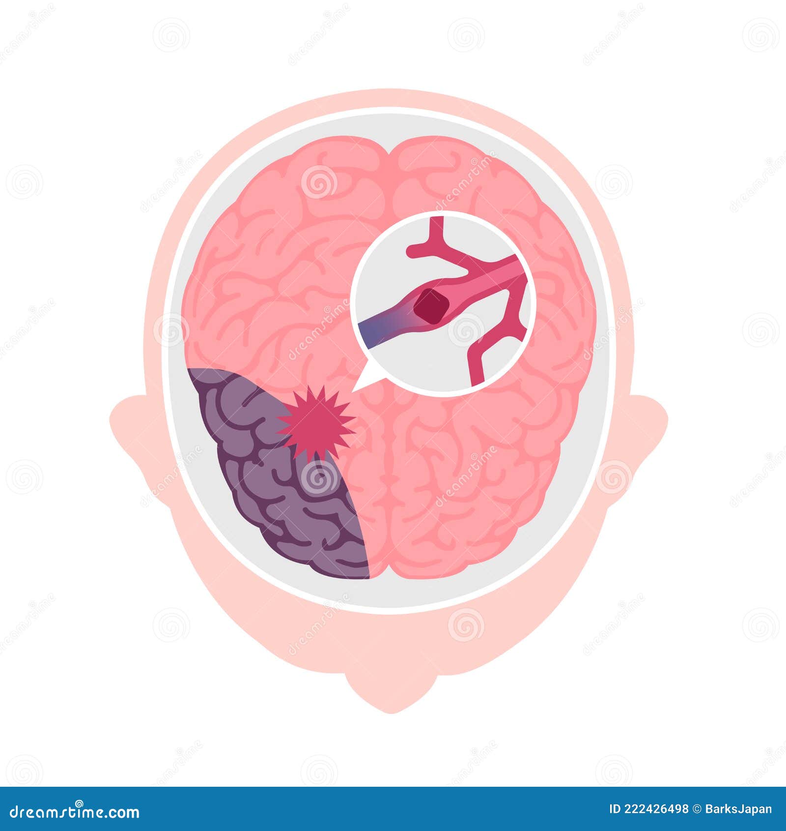 Types Van Hersenberoerte Vectorillustratie Herseninfarct Vector ...