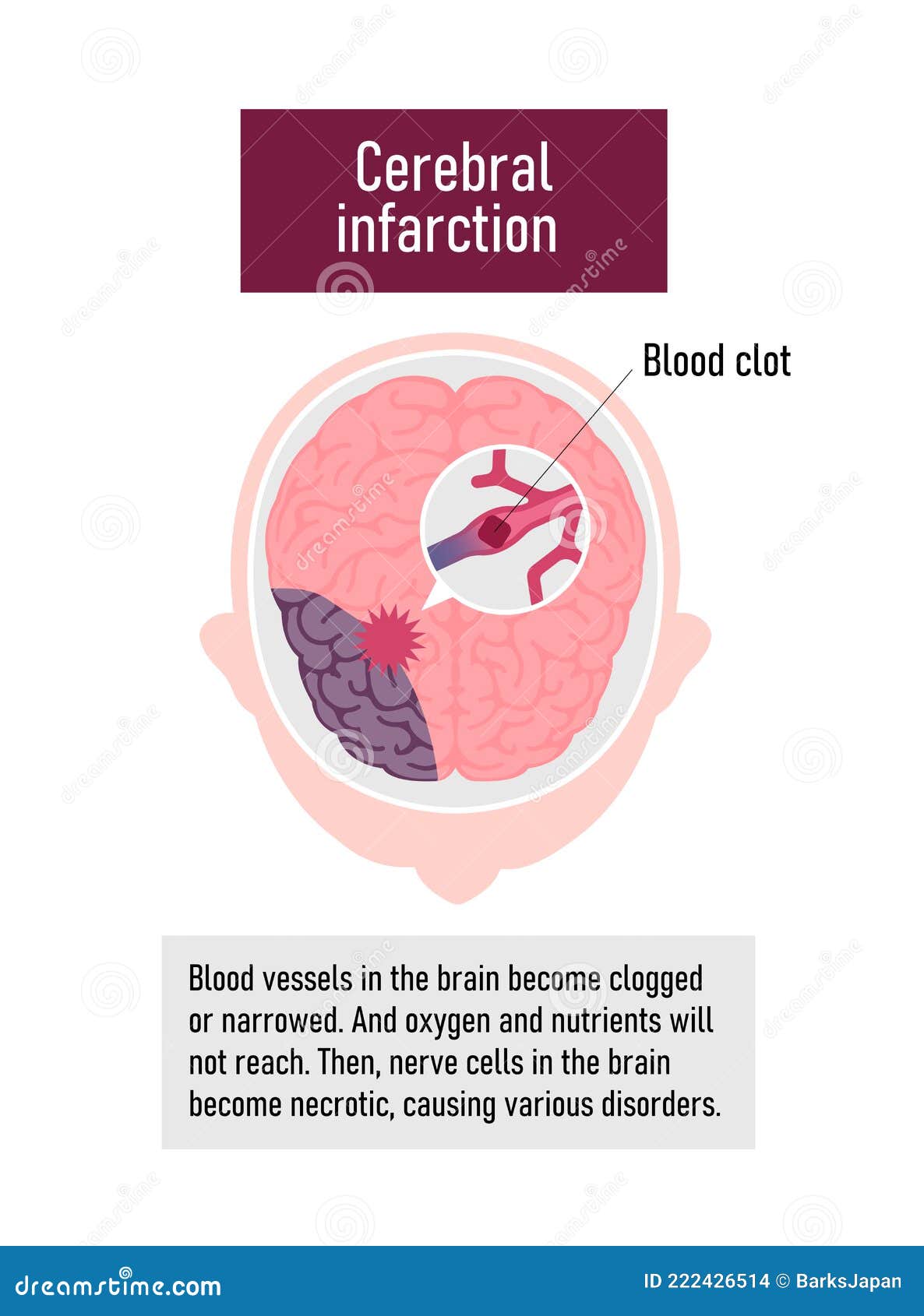 Types Van Hersenberoerte Vectorillustratie Herseninfarct Vector ...