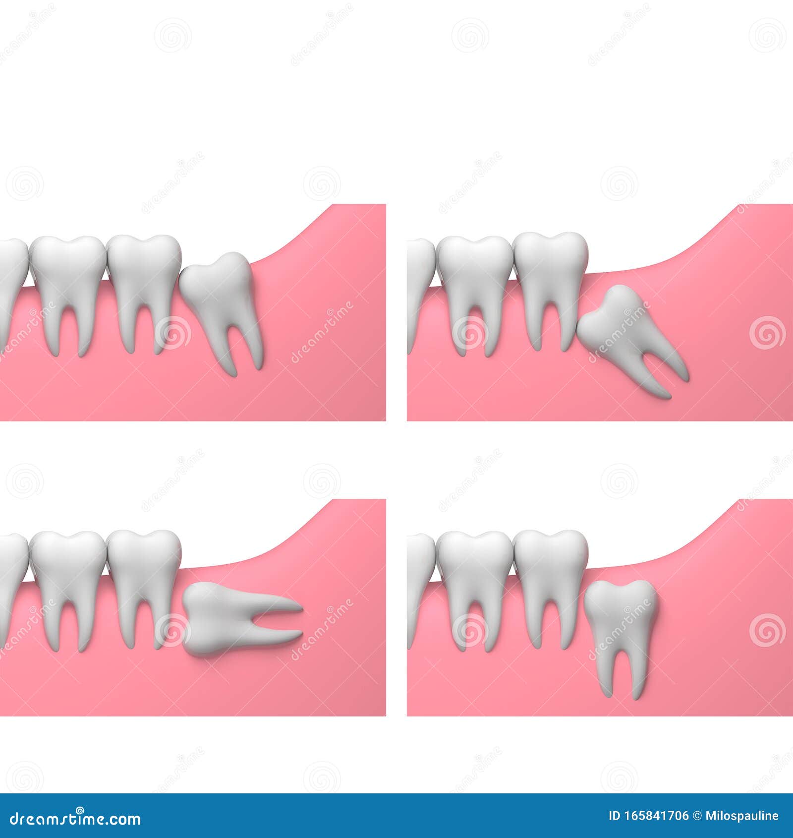 Types of Wisdom Tooth Impactions, White Background, Collage, 3D-render ...