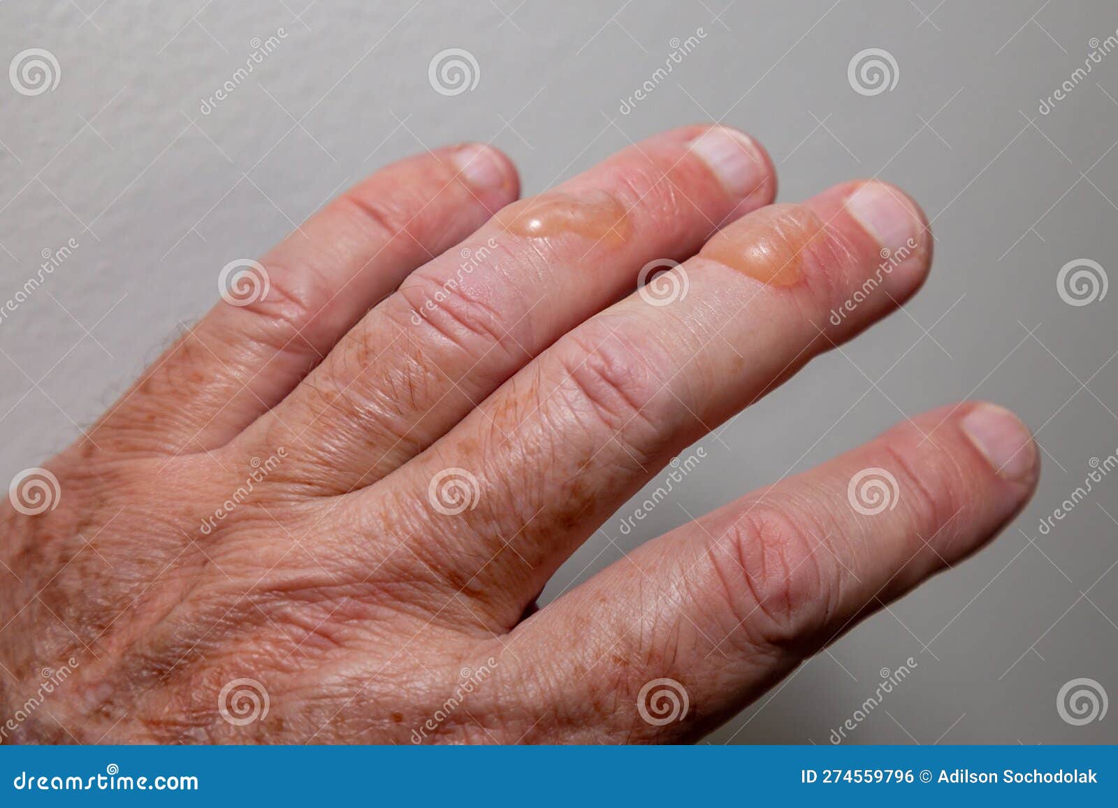 Typical Blisters on the Skin from Second-degree Burning by Boiling Oil ...