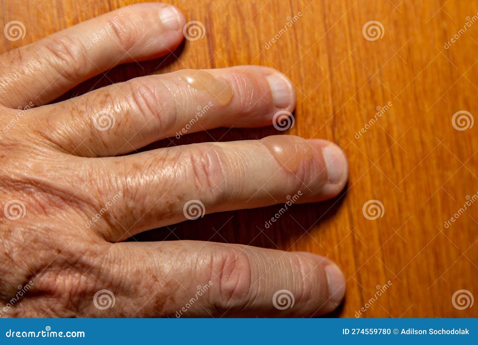 Typical Blisters on the Skin from Second-degree Burning by Boiling Oil ...