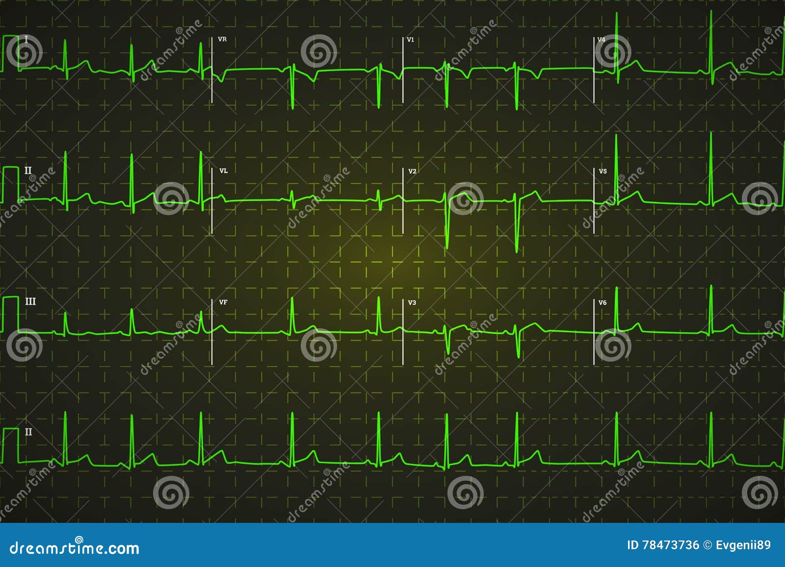 Typical Human Electrocardiogram, Bright Green Graph on Dark Background ...