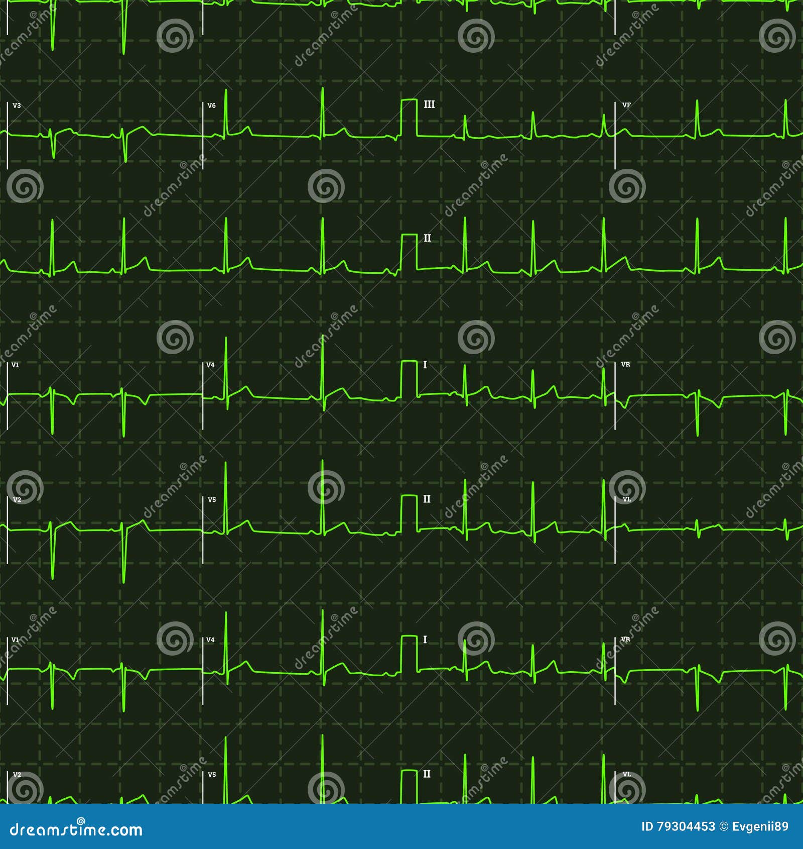 Typical Human Electrocardiogram Green Graph on Dark Background ...