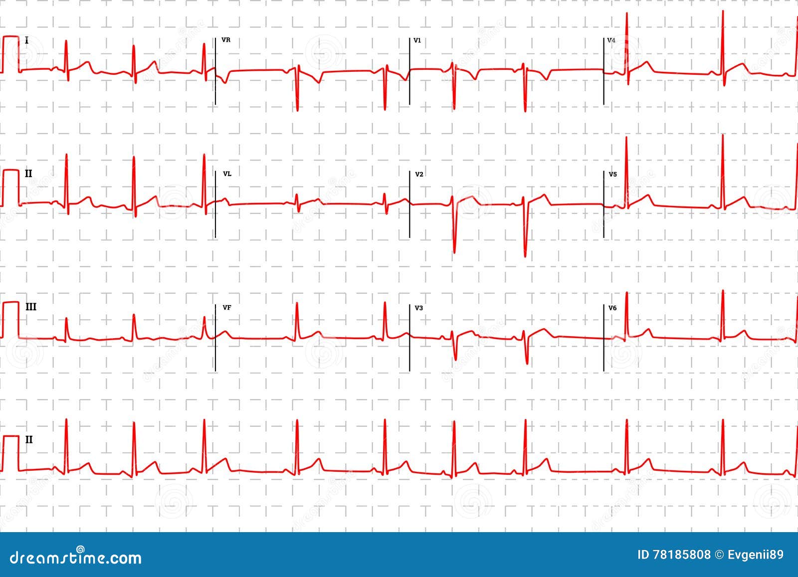 Typical Human Electrocardiogram, White Graph On Dark Blue Background ...